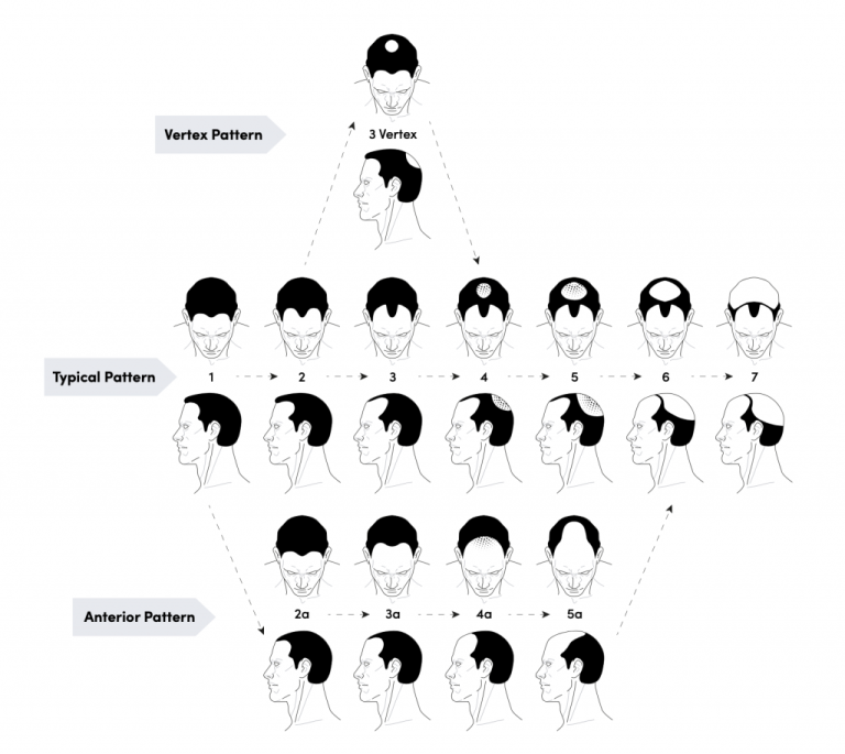 Hair Loss Patterns - How Many Grafts Do You Need? | Ideal of MeD