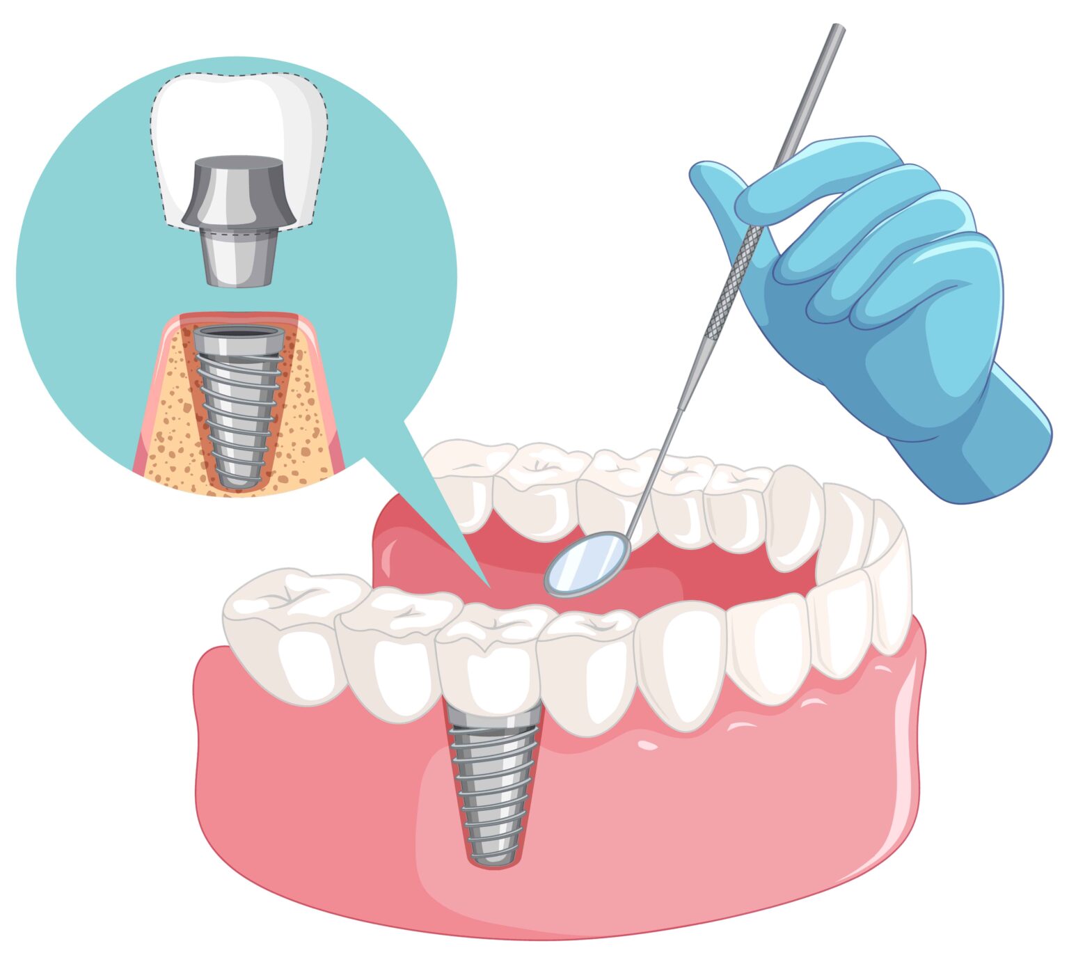 Molar Teeth Implant: Complete Guide to Replacing Teeth Safely